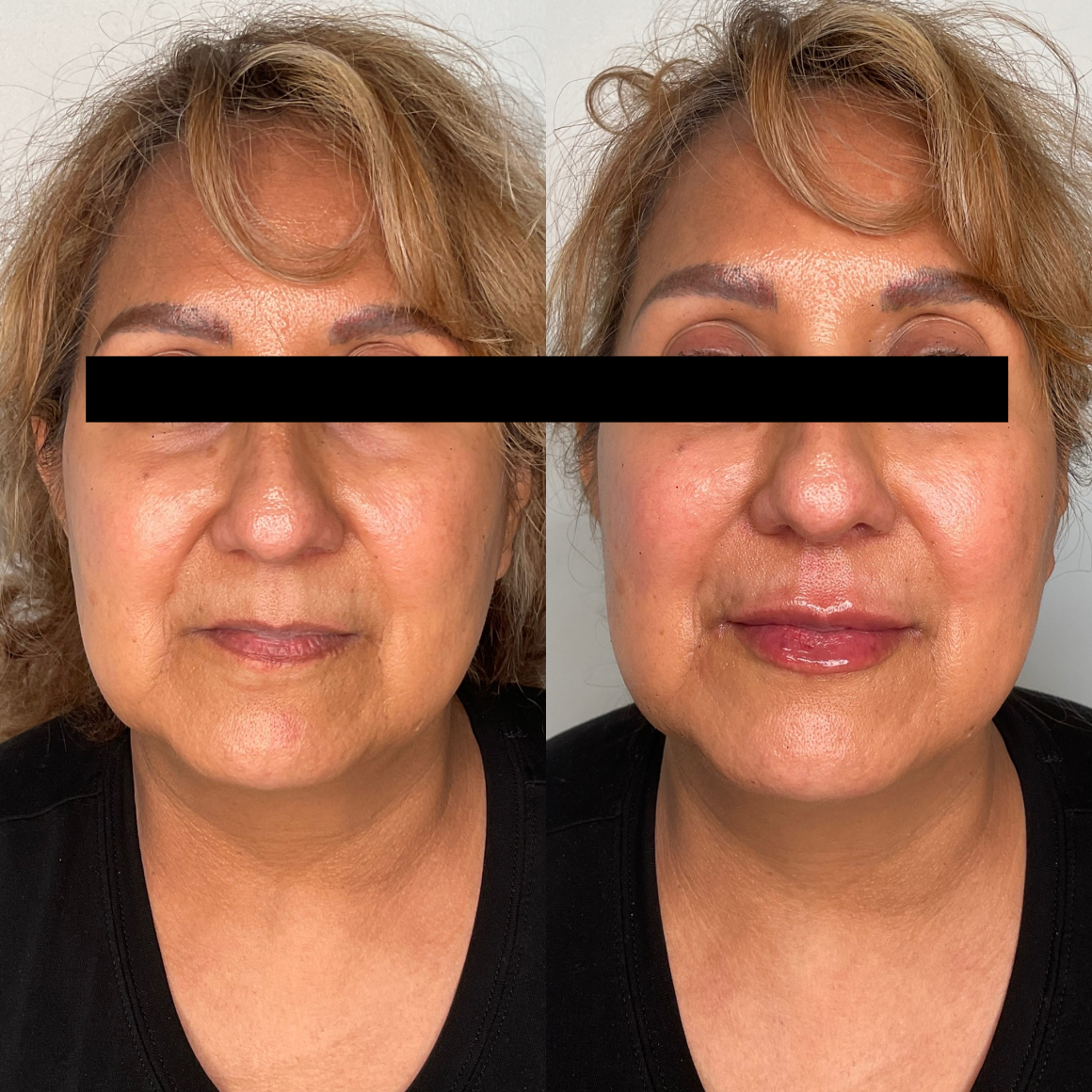 The Hive MedSpa - Botox Clinics El Paso, TX | Botox Services El Paso ...